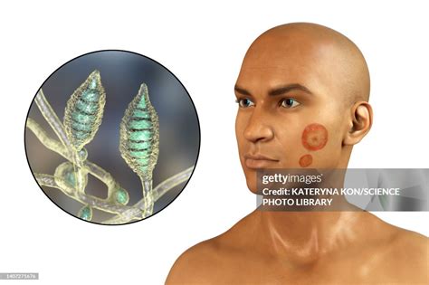 Ringworm Illustration High Res Vector Graphic Getty Images