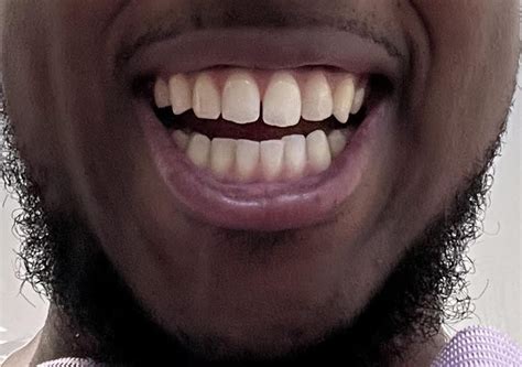 Time Before Seeing Progress In Front Teeth Gaps R Invisalign