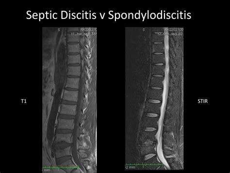 Septic Discitis V Spondyl