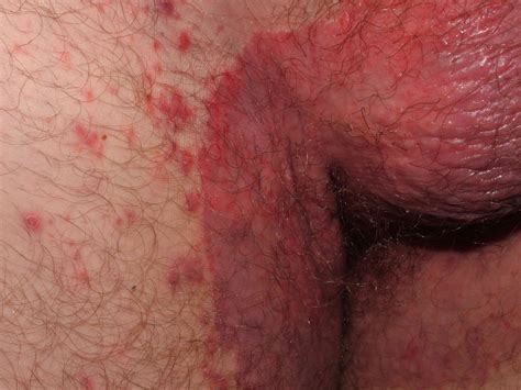 14 Possible Causes Of Itchy Balls Pruritus Scroti