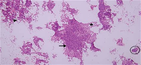 Cribriform Morular Variant Of Papillary Thyroid Carcinoma C