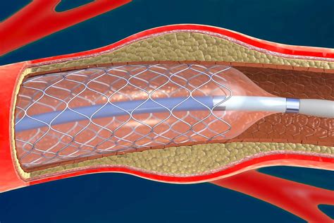 Transcarotid Artery Revascularization Tcar Conditions And Treatments