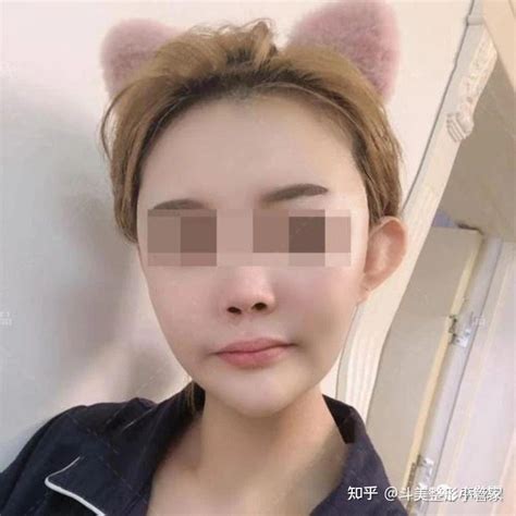 高颧骨女生如何医美逆袭：自体脂肪填充太阳穴效果怎么样？国内有哪些靠谱的自体脂肪填充医生？ 知乎