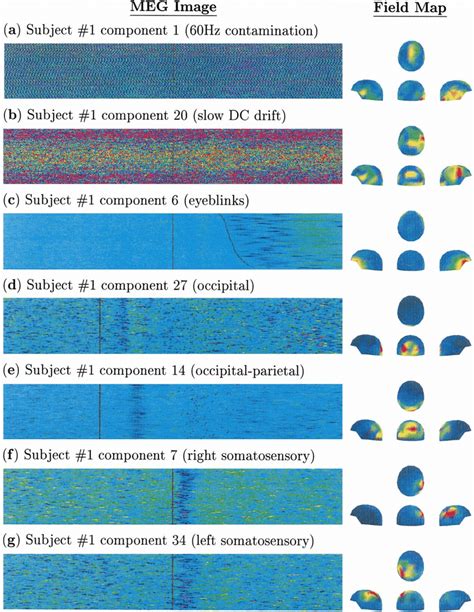 Separation Of Noise Sources And Neuronal Components Using Blind Source