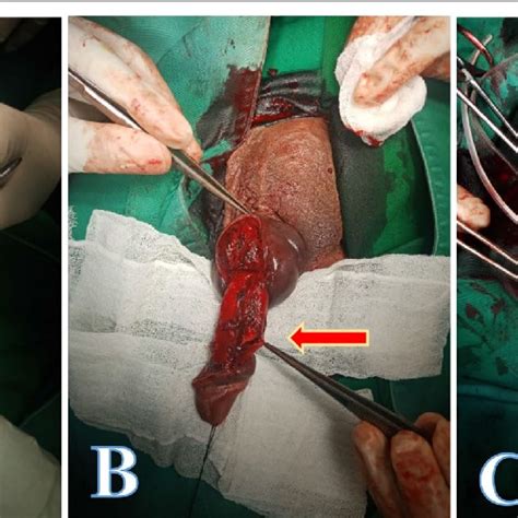 A Surgical Exploration Via Subcoronal Incision B Degloving Incision