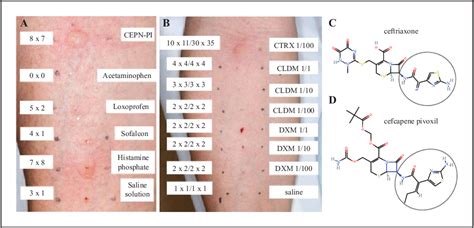 Figure 1 From Cross Reactivity Of Cephalosporins Allergic Immediate Hypersensitivity To