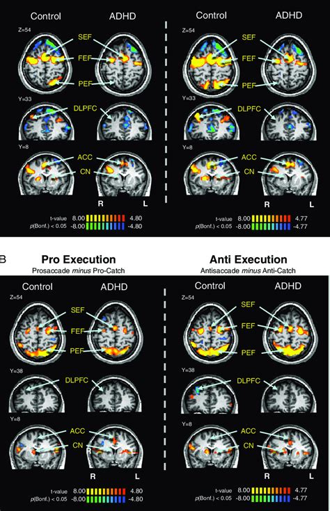 Saccade Preparation A And Saccade Execution B Contrast Maps A Download Scientific