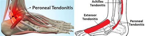 Peroneal Tendonitis Causes And Treatments