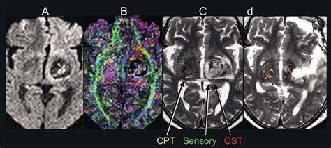 Diffusion Tensor Imaging Using A Spin Echo Stejskal Átanner Sequence