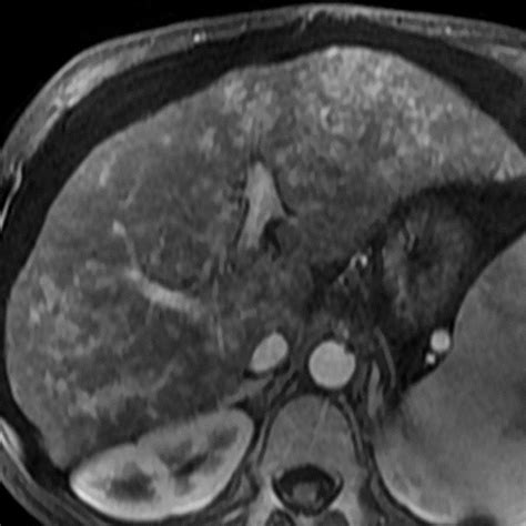 Hcc Eovist Radiology At Lawrence Henry Blog