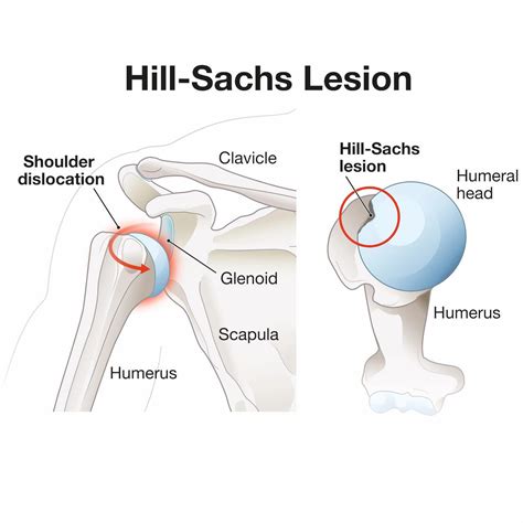 Bankart Lesion Tear Beacon Orthopaedics