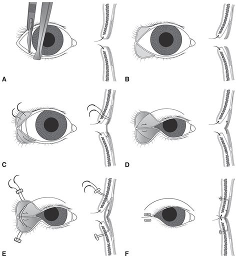 Treatment Of Ocular Surface Disorders Ento Key