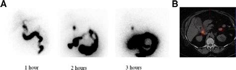 Hepatobiliary Scintigraphy In 2014 Journal Of Nuclear Medicine
