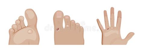 Friction Blisters Developing On Foot And Hand Skin Stock Illustration