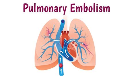 Pulmonary Embolism සිංහලෙන් Youtube