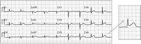 Electrocardiographic Differential Diagnosis Of St Segment Elevation