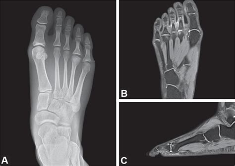 Metatarsal Head View