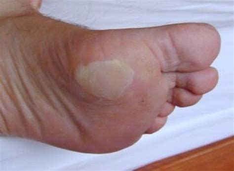 Blisters Causes And Treatment Artofit