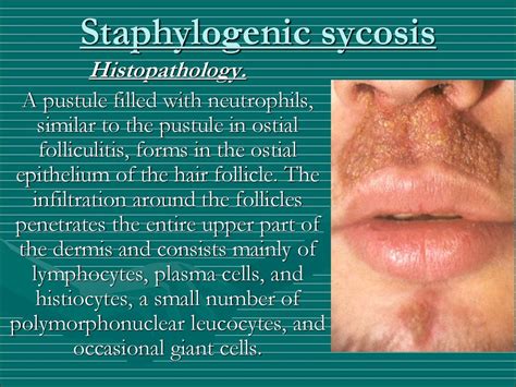 Pyoderma And Scabies Online Presentation