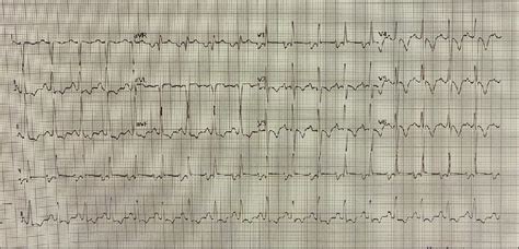 12 Lead Electrocardiogram Showing Right Axis Deviation Right