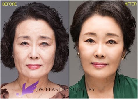 Facelift In Korea At Joey Henriquez Blog