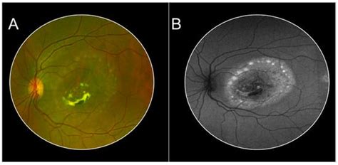 Retinal Imaging Findings In Inherited Retinal Diseases