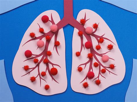 4 Big Things You Should Know About Primary Immunodeficiency Diseases Self