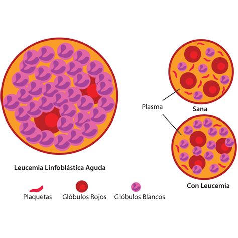 Leucemia Leucemia O Que E Tipos Causas Diagnostico E Tratamento Tua