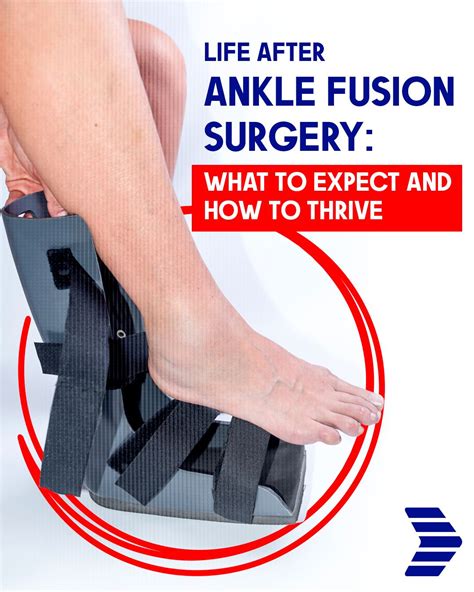 Anklefusionsurgery Anklepainrelief Arizona Podiatrist