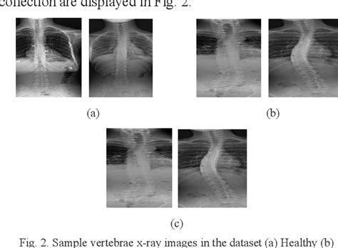 Figure From Automated Vertebrae Diagnosis In Spinal X Ray Images Using Artificial Intelligence