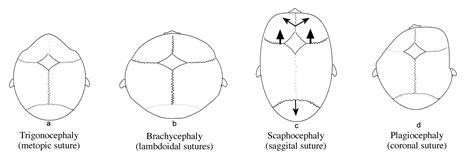 Coronal Synostosis