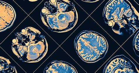 Reactive Tinnitus The Definitive Guide Neuromed Tinnitus Care