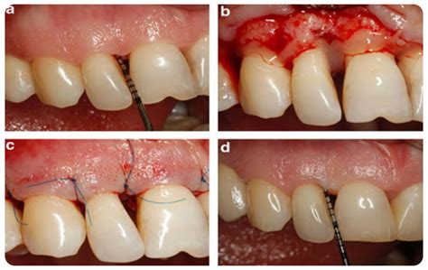 Its Dental Clinic Best Dental Clinic In Ghaziabad Gingival Flap Surgery