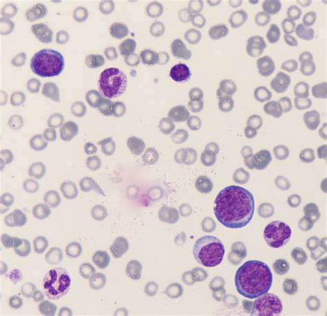 Circulating Erythroblasts