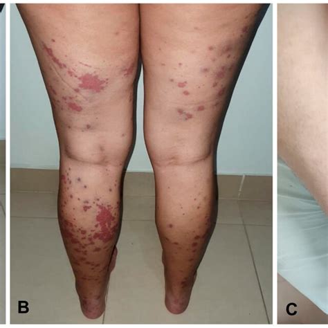 Patient With Extensive Ulcerative Colitis In Deep Remission On