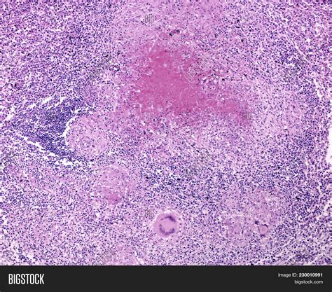 Caseous Necrosis In Tb