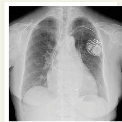 Posteroanterior View Of The Chest Radiograph After Pacemaker