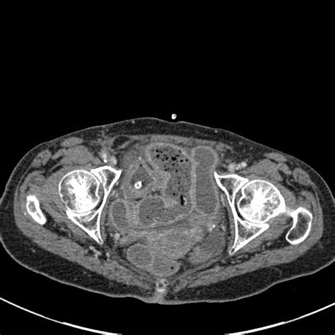 Small Bowel Faeces Sign Pacs