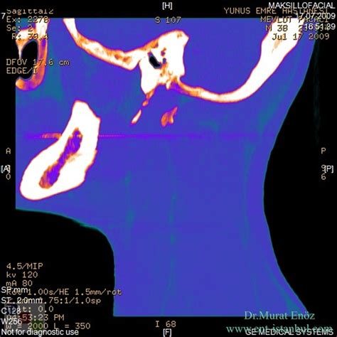A Rare Case Report Fracture Of The Styloid Process And Its Clinical