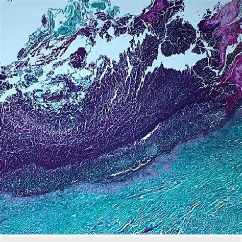 Umbilicated Papules And Nodules With Central Keratine Plug A