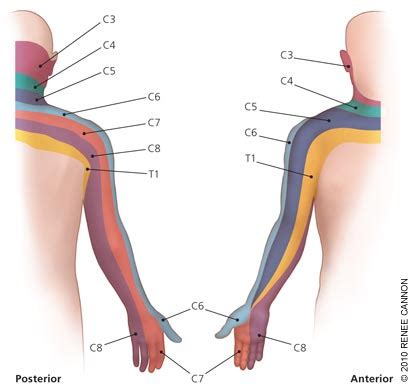 Your Physio Cervical Radiculopathy