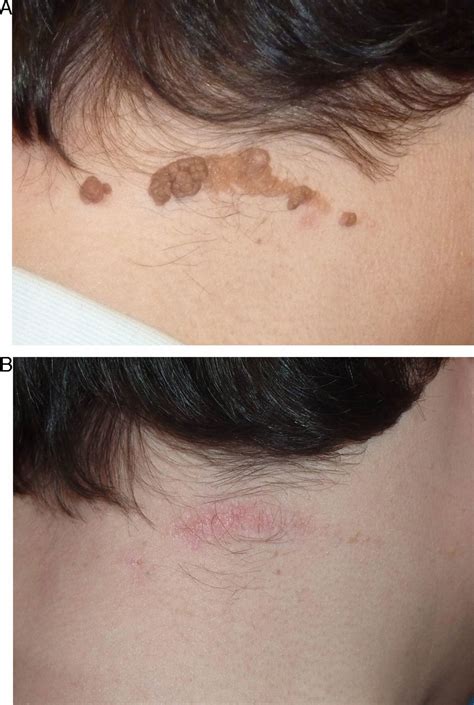 Epidermal Nevus Removal