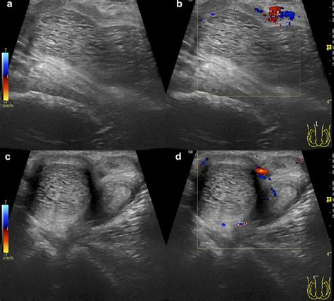 Ultrasound 2a 2c At The Base Level Of The Penis Revealed A
