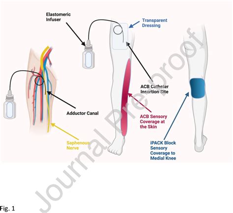 Figure 1 From Implementation And Postoperative Management Of Continuous