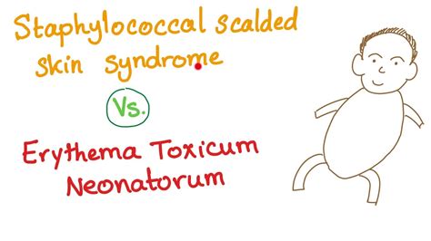 Staphylococcal Scalded Skin Syndrome V S Erythema Toxicum Neonatorum