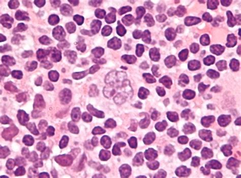 Lymphocyte Rich Vs Lymphocyte Predominance Hodgkin Lymphoma