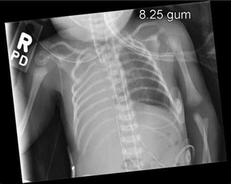 Chest X Ray Of Second Case Showing Total Opacification Of Right Lung Download Scientific Diagram