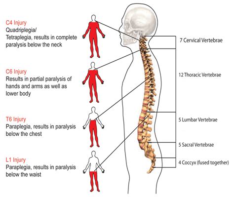 Paraplegia Causes