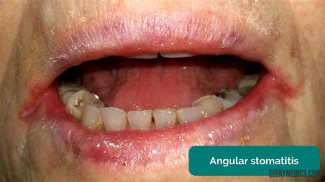 Paediatric Cardiovascular Examination Osce Guide Geeky Medics