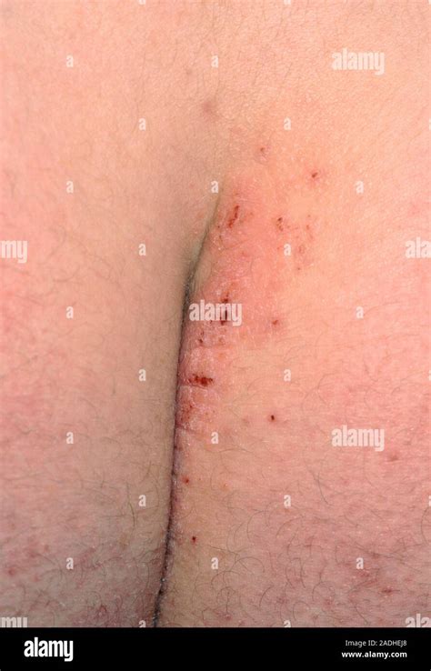 Eczema Close Up Of Eczema At The Top Of The Cleft Between The Buttocks